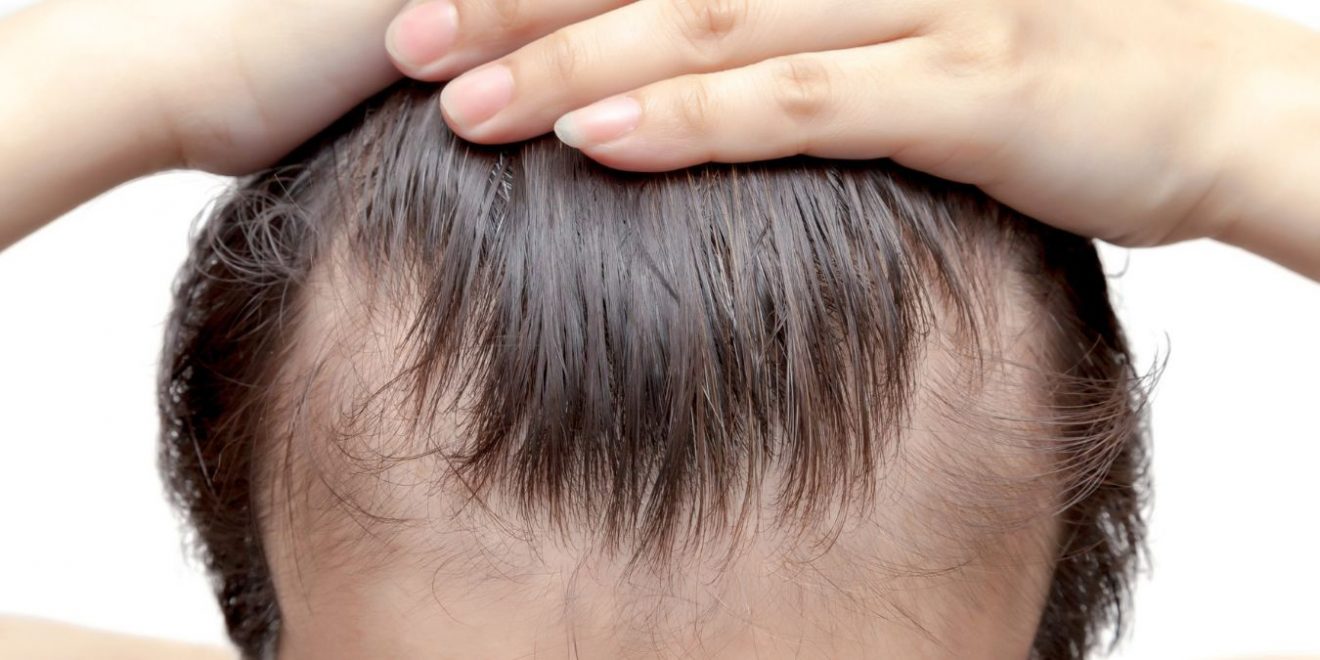 Best Haircut For Receding Hairline And Thinning Hair - Your Holiday ...